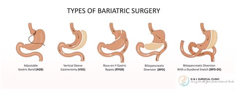 Introducing Bariatric Surgery G L Surgical Clinic Dr Ganesh