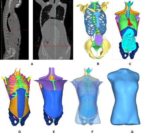frontiers determination of three dimensional corrective force in adolescent idiopathic