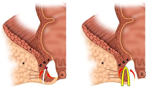 Anorectal Fistula Classification