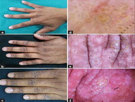 Acrokeratosis Verruciformis Of Hopf A Series Of Cases Wit