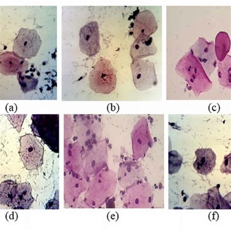 pdf inflammatory cell extraction and nuclei detection in pap smear images