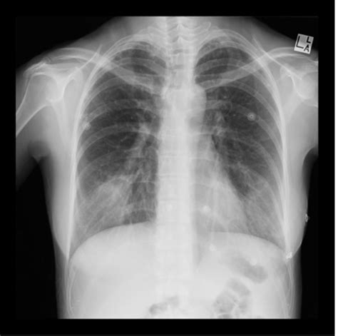 Dm Ii Chest X Rays Flashcards Quizlet