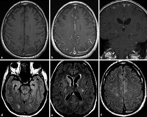 Abnormal Brain Mri Without Contrast
