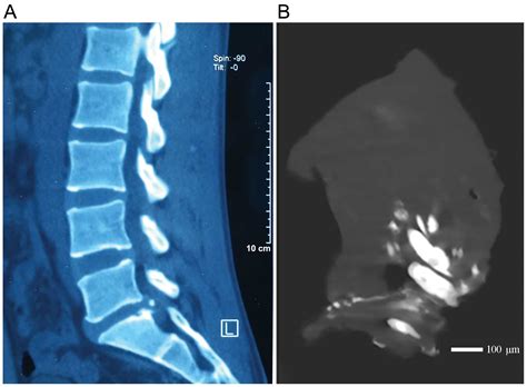 Herniated Disc CT Scan