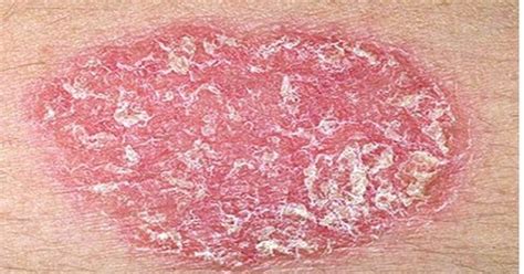 Dermatology Secondary Skin Lesions Flashcards Quizlet