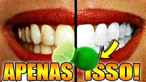 Como Tirar Tártaro dos Dentes APENAS 1 Aplicação Dessa Receita