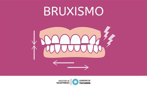 Bruxismo Una Problem Tica Que Aument Por El Estr S Generado En La