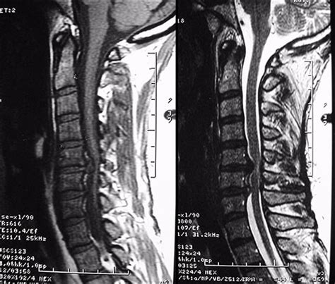 Cervicalgia Hérnia de disco cervical Entenda sua doença
