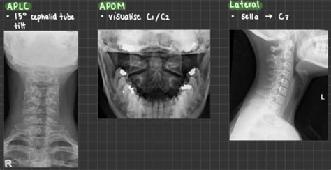 Cervical Spine Imaging Flashcards Quizlet