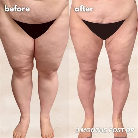 Una Gu A Completa Sobre Las Etapas Y Tipos De Lipedema