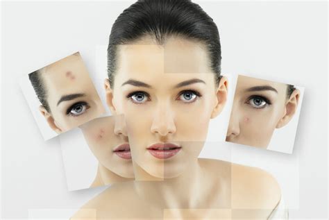 Consejos Para Eliminar Cicatrices Del Acn Estilo De Vida Bienestar