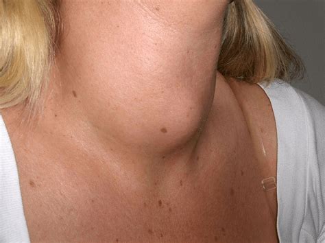 Goiter Punca Simptom Dan Cara Rawatan The Diagnosa