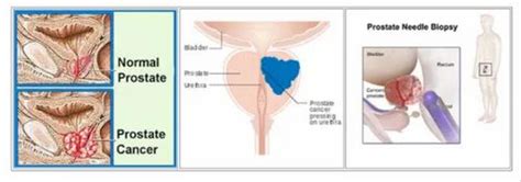 Turp Prostate Shaved Prostate Telegraph