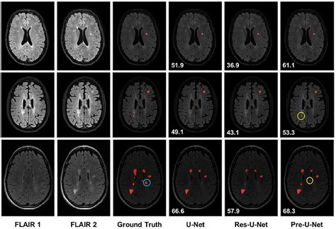 frontiers new multiple sclerosis lesion segmentation and detection using pre activation u net
