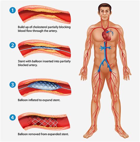 PCI Coronary Artery Disease Treatment REVA
