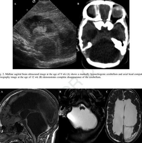 Midsagittal T1 A And Axial T2 B Weighted Magnetic Resonance Images