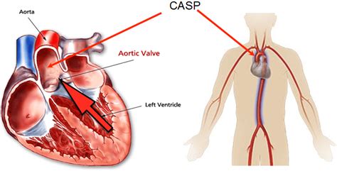 Central Aortic Systolic Pressure Casp Peter Yan Cardiology Clinic