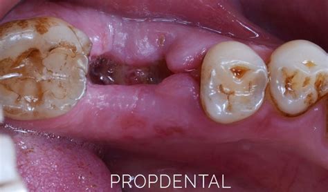 Infecciones dentales tras una extracción de muela Qué debes hacer