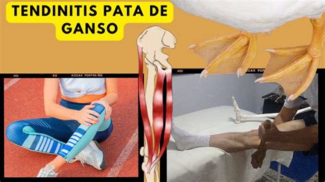 Tendinitis Pata De Ganso Que Es Tratamiento YouTube