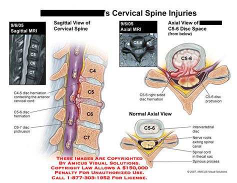 AMICUS Illustration Of Amicus Injury Cervical Spine Disc Herniation C5