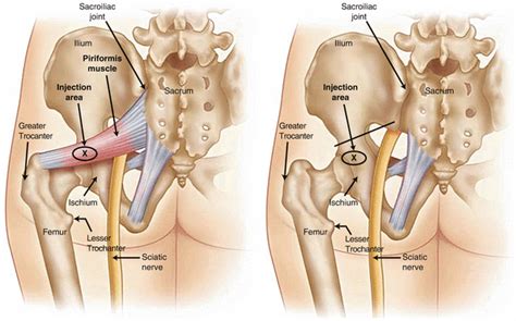 Piriformis Injection Radiology Key