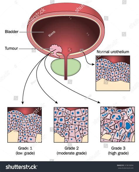 Tumour Bladder Wall Showing Normal Urothelial