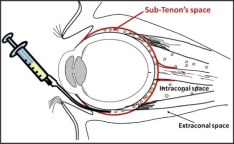 Ocular Pharmacokinetics Part Iii Ocular Injections Flashcards Quizlet
