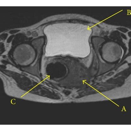 Extensive Condyloma Acuminata Of The Vulvar And Perianal Regions