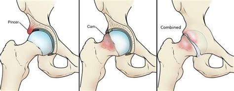 Femoroacetabular Impingement FAI Complete Physio