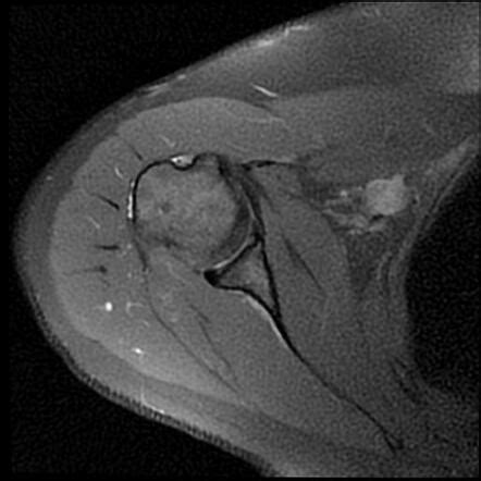 Biceps Brachii Long Head Tendon Rupture Radiology Case Radiopaedia Org