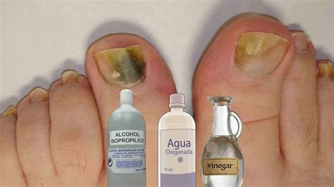 La Duraci N M Nima De Este Tratamiento Para Eliminar Los Hongos De Las