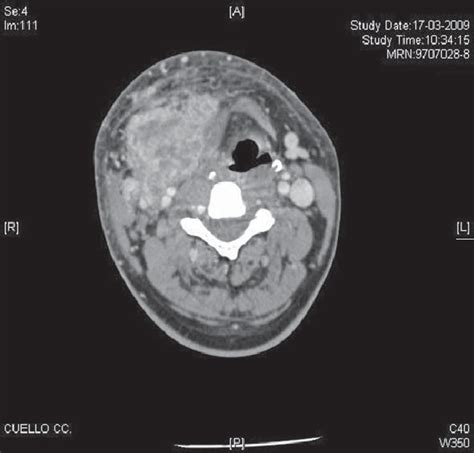 Tomografía axial computada de cuello con contraste que demuestra lesión