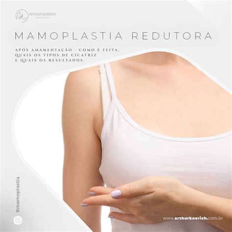 Mamoplastia Redutora após amamentação como é feita quais os tipos de