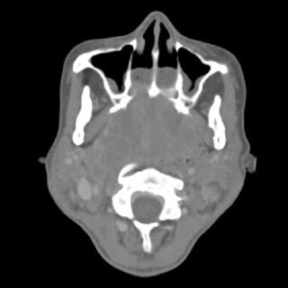Sagittal Plane Computed Tomography Of The Head A Large Mass