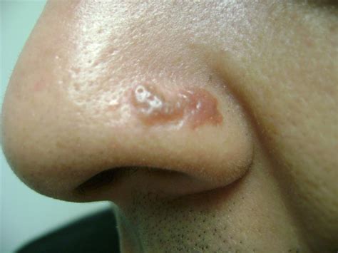 Granuloma Facial PIEL L Latinoamericana