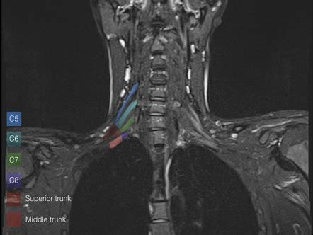 Brachial Plexus Radiology Reference Article Radiopaedia Org