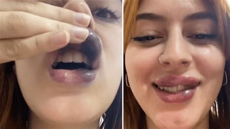 Complicação de preenchimento labial viraliza Medo de a boca explodir