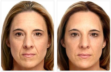 Travieso excitación champú precio poner hilos tensores rostro