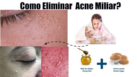 Como Eliminar MILIUM Las BOLITAS De GRASA YouTube