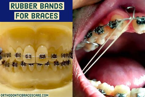 Braces Rubber Bands Purpose Types Colors How To Put Orthodontic