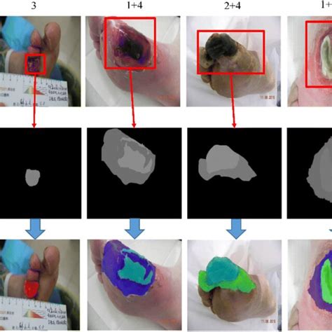 The Wagner Ulcer Classification System With 5 Different Symptoms DFU
