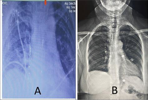 Chest Radiography Done On The Second Day Postoperation Showing White
