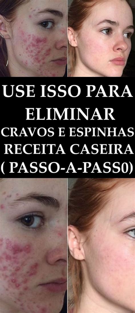 Eliminarrugas DiyForYou Espinhas no rosto Remédio para espinhas