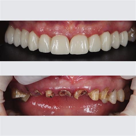 Casos reales Clínica Dental Blay Monzo