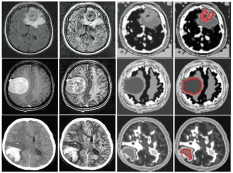 bdcc free full text automatic human brain tumor detection in mri image using template based