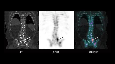 SPECT CT Imaging In The Evaluation Of Pain Following Spinal Fusion