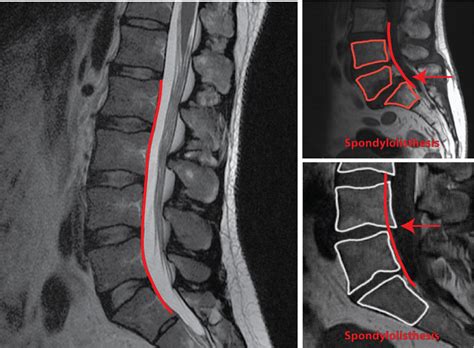 Healthcare Extreme How To Read An MRI Lumbar Spine In 8 Easy Steps Mri