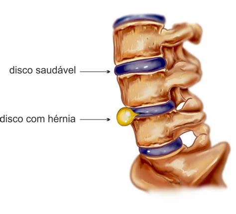 Hérnia de Disco O que é e como tratar Saúde Benessere Saúde