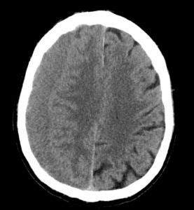 Hematoma Subdural Agudo Cr Nico Secuelas