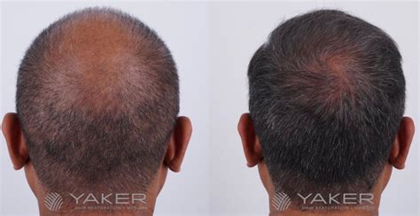 Amazing Hair Transformation Results With Dr Yakers Topical Finasteride